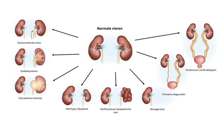 Aangeboren nier- en urinewegaandoeningen - Artdeco Study